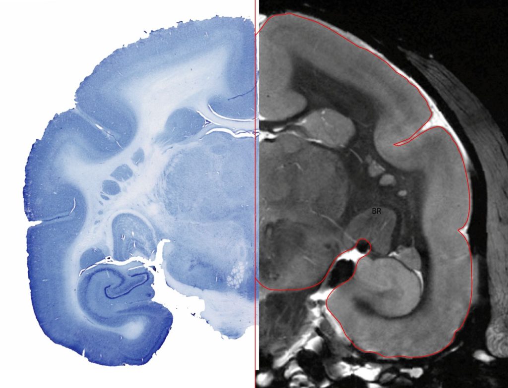 MRI Brain Atlases - Ekam Imaging